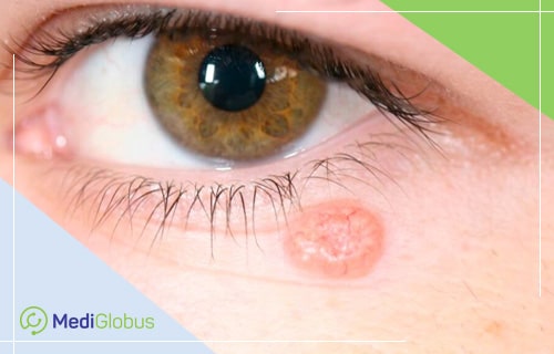 Basal cell carcinoma treatment | MedicGlobus